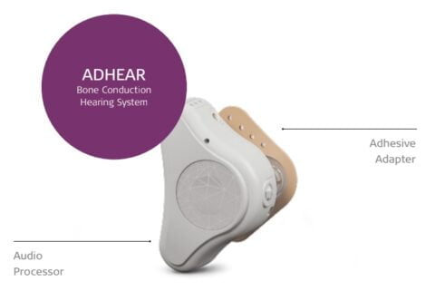 ADHEAR Bone Conduction Hearing System - HearMed